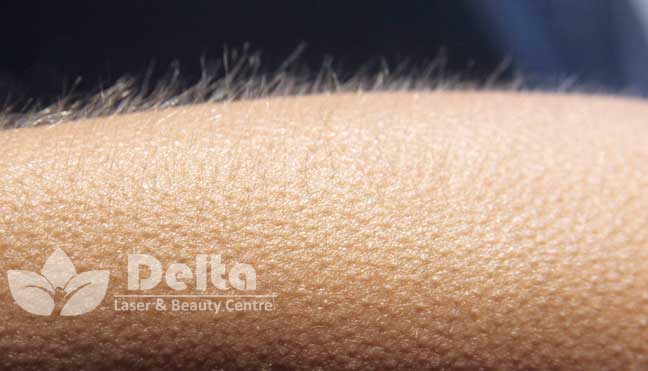 آیا لیزر موهای نازک باعث ضخیم تر شدن آن می شود؟ - کلینیک دلتا